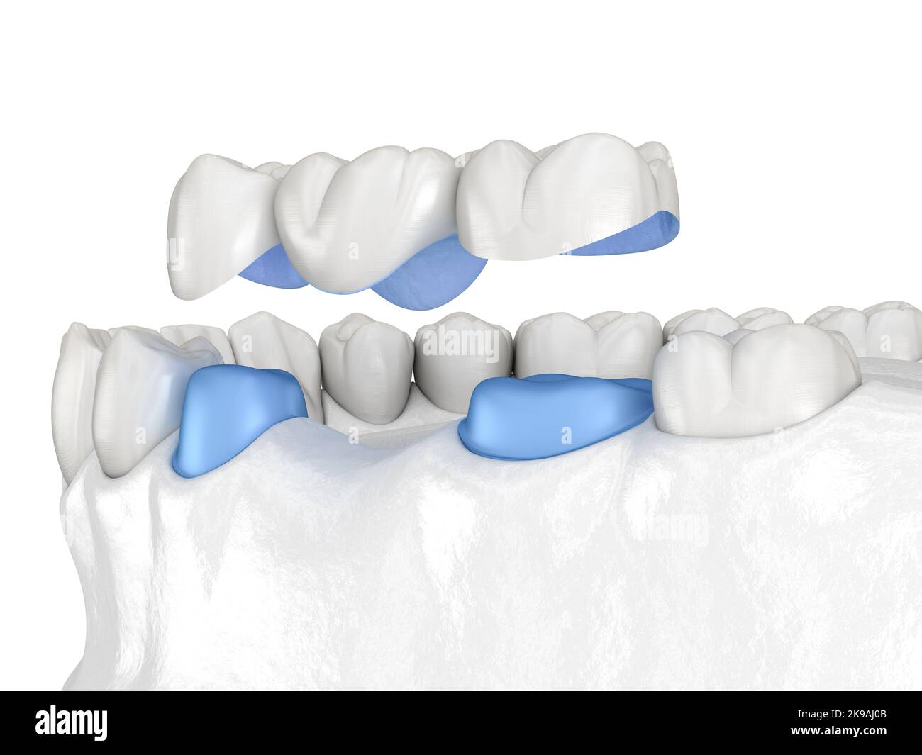 Porcelain Dental bridge of 3 teeth over molar and premolar. Medically ...