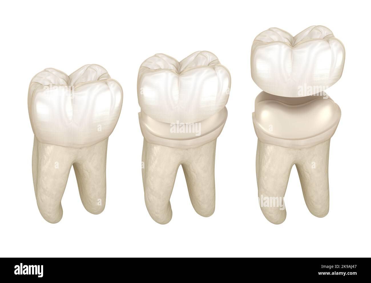 Porcelain crown placement over molar tooth. Medically accurate 3D ...