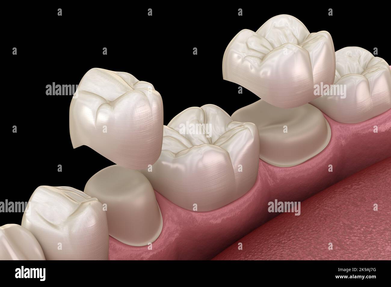 Porcelain crowns placement over premolar and molar teeth. . Medically ...