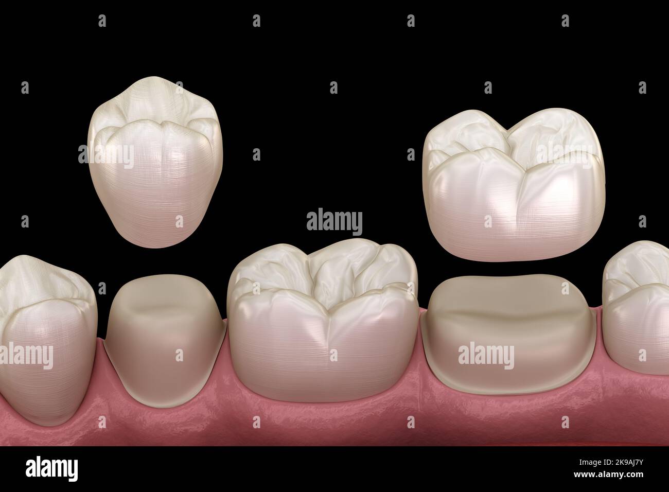 Porcelain crowns placement over premolar and molar teeth. . Medically ...