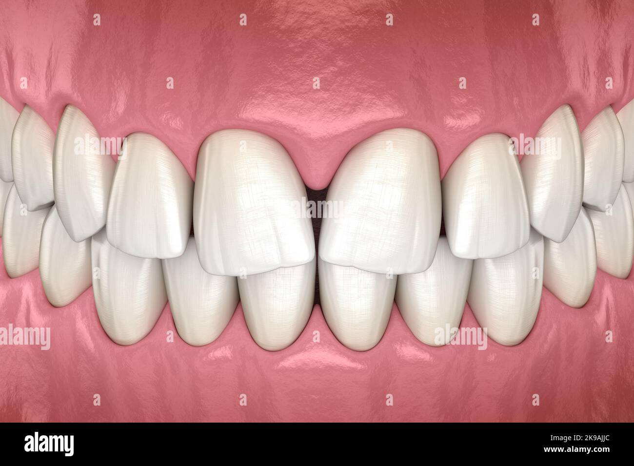 Convergent diastema of central incisors teeth. Dental disfunction 3D ...