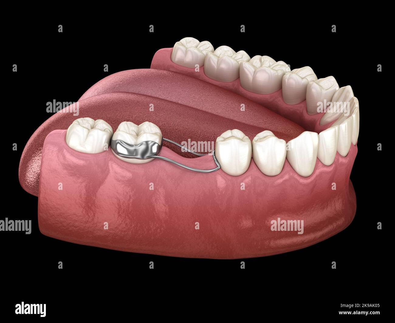Space Maintainer Unilateral keeps from teeth shift deformatiuon after ...