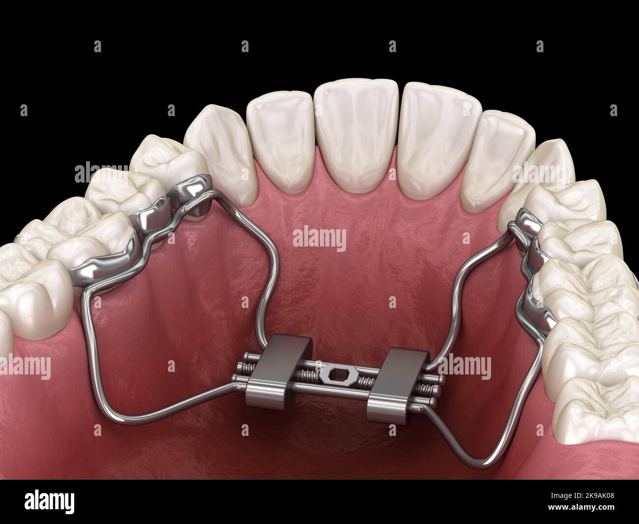 Rapid Palatal Expansion. Medically accurate tooth 3D illustration Stock ...