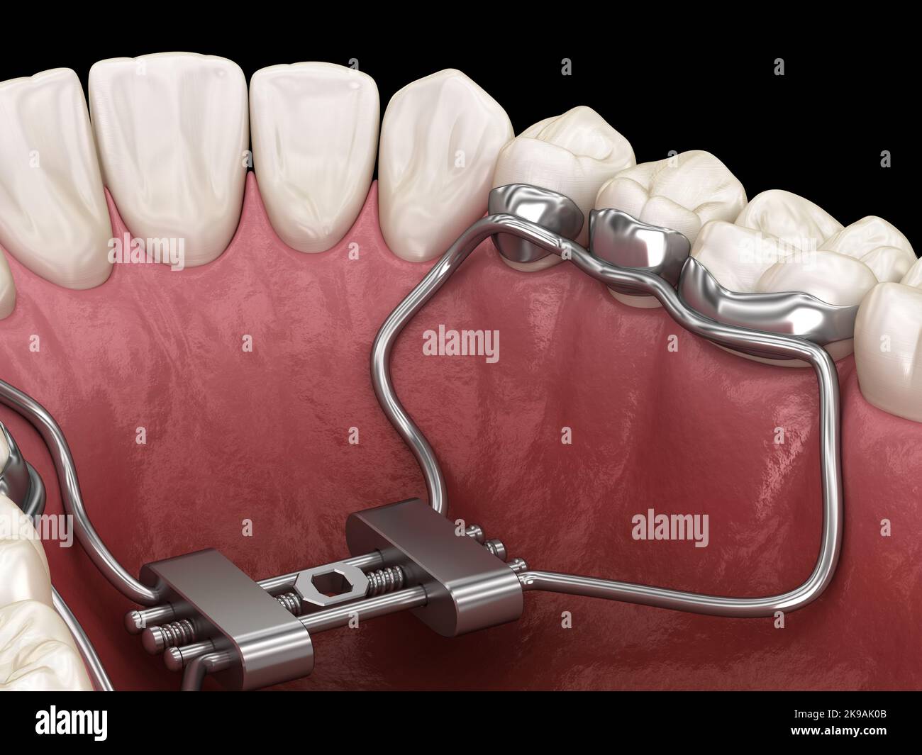 Rapid Palatal Expansion. Medically accurate tooth 3D illustration Stock ...