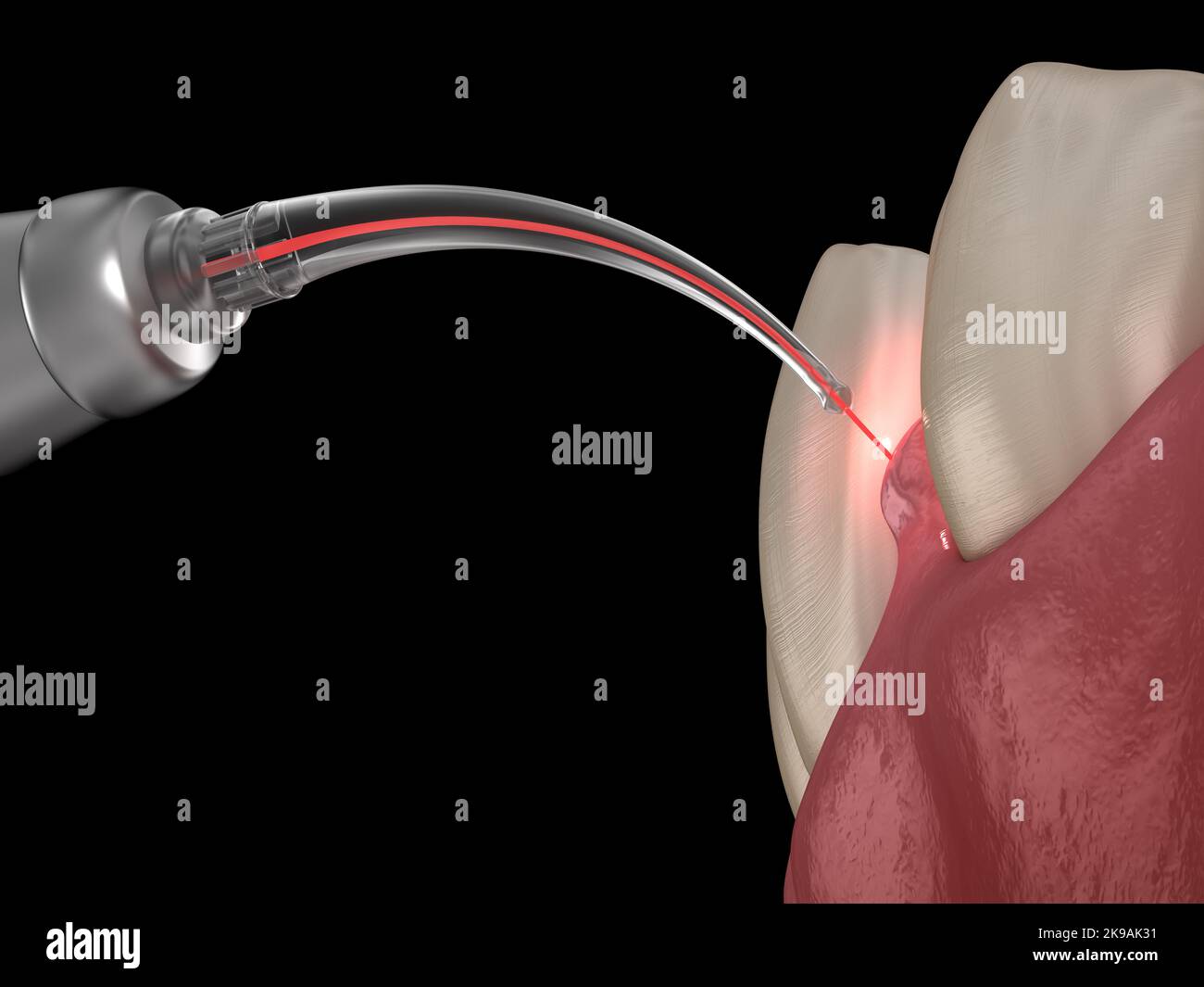 Gum correction surgery with laser. Medically accurate tooth 3D ...