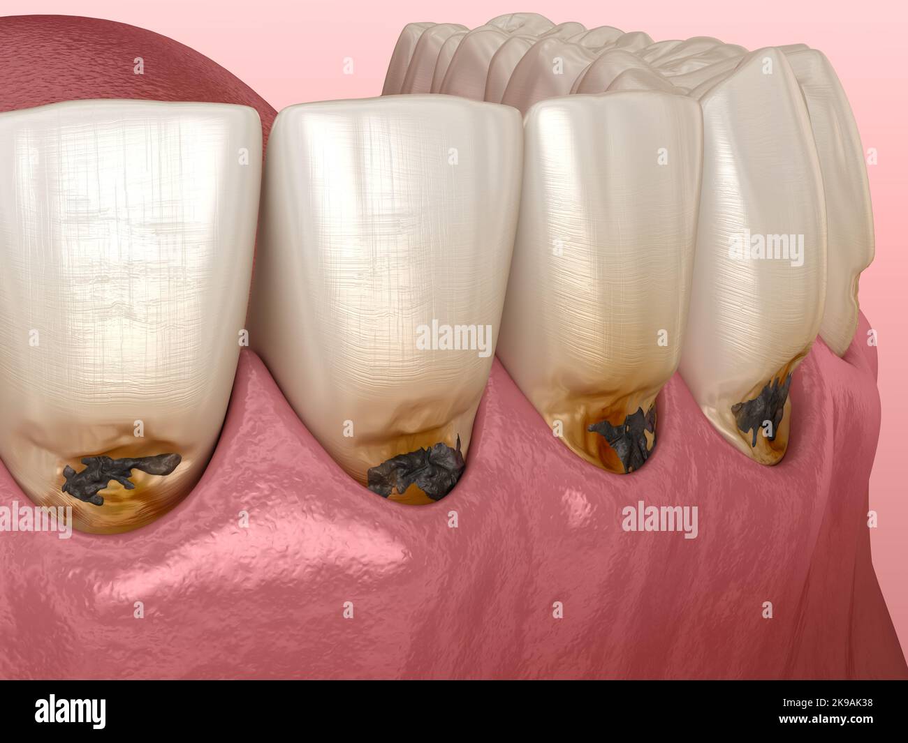 Cervical Caries On Frontal Teeth Medically Accurate Tooth 3d