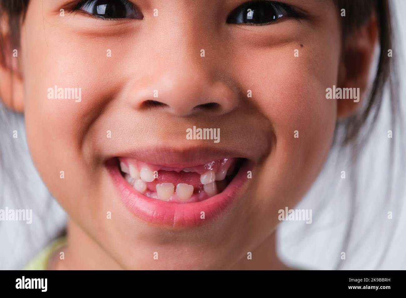 Portrait of an Asian girl with broken upper baby teeth and first ...