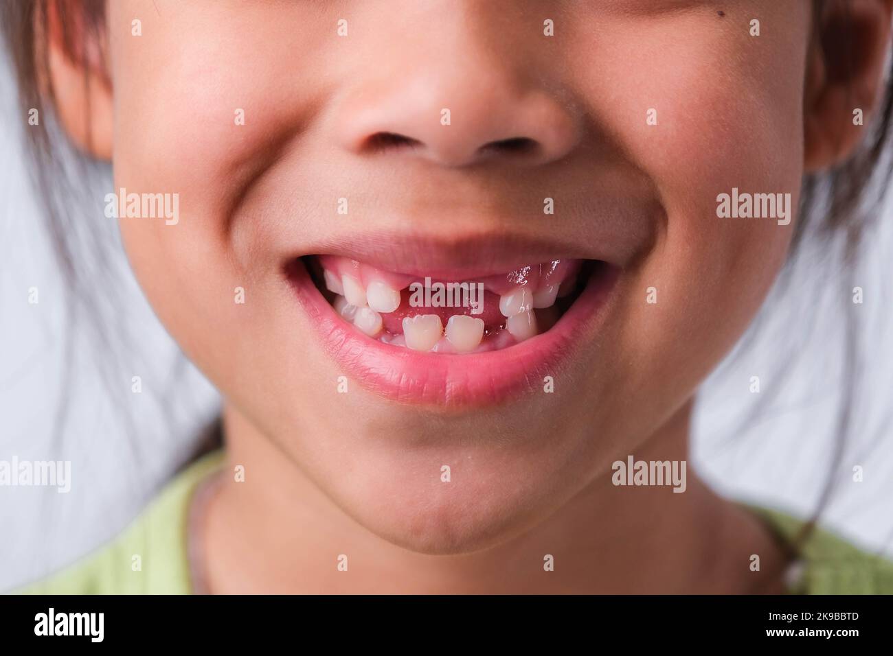 Close-up of a girl with broken upper baby teeth and first permanent ...