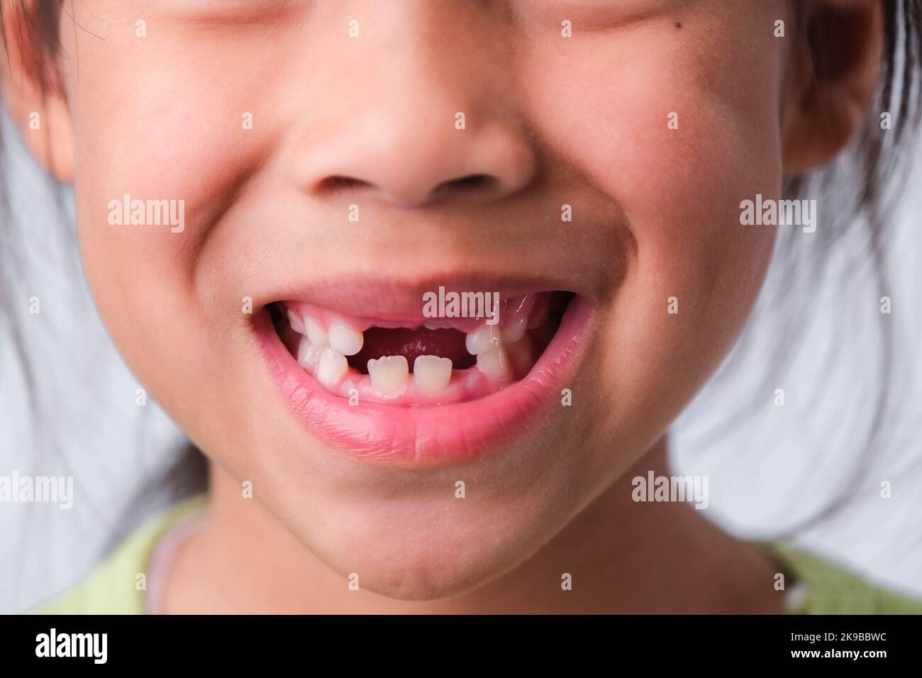 Close-up of a girl with broken upper baby teeth and first permanent ...