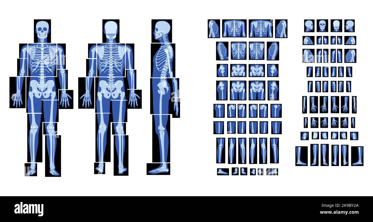 Set of X-Ray Skeleton Human body - hands, legs, chests, heads, vertebra ...