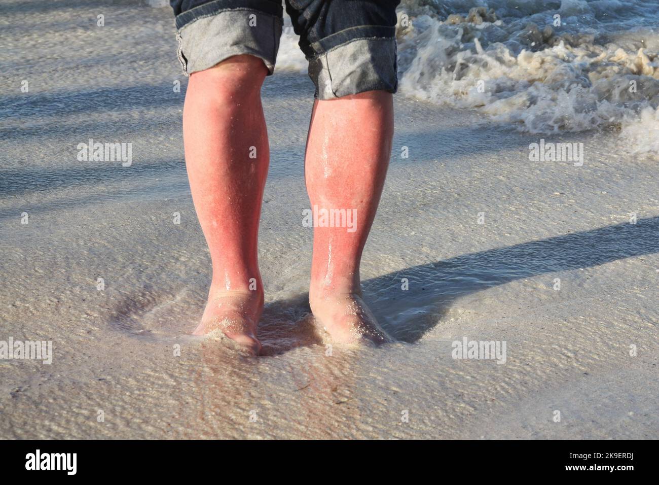 Skin sun burnt hi-res stock photography and images - Alamy