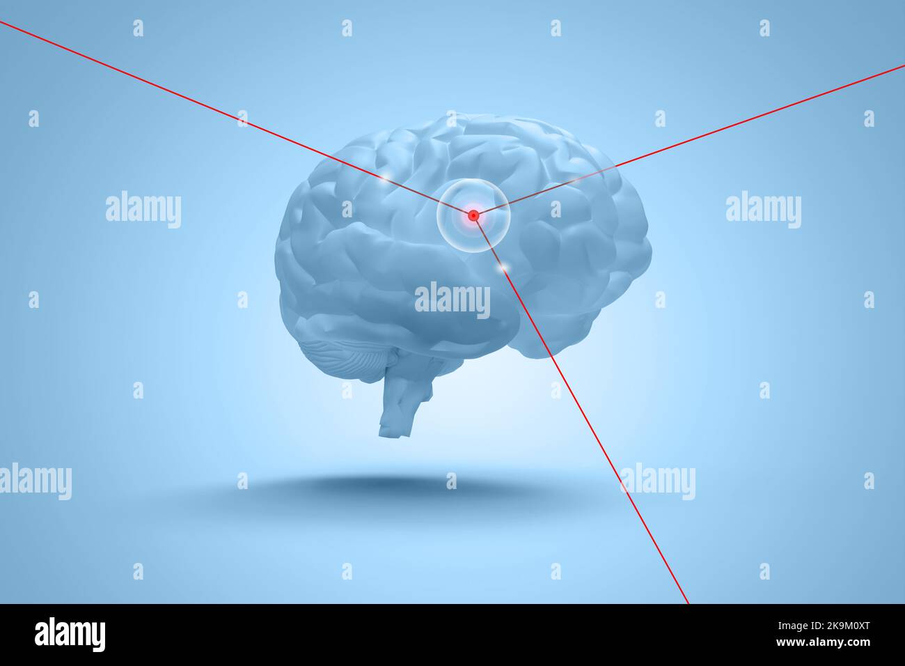 Brain surgery laser hi-res stock photography and images - Alamy