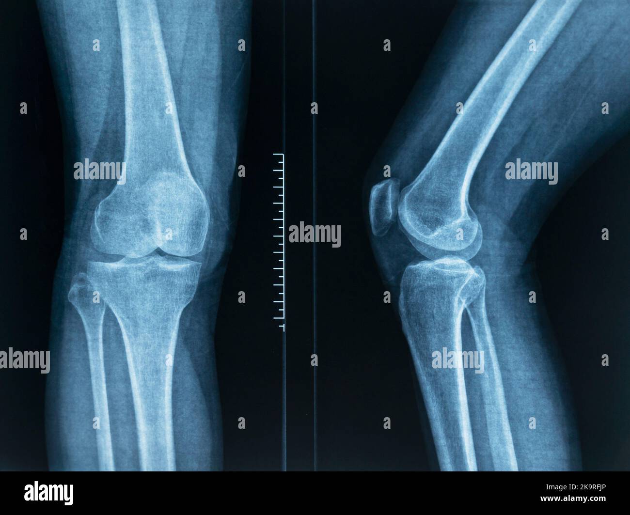 radiography of a young male arm humerus on top Stock Photo - Alamy