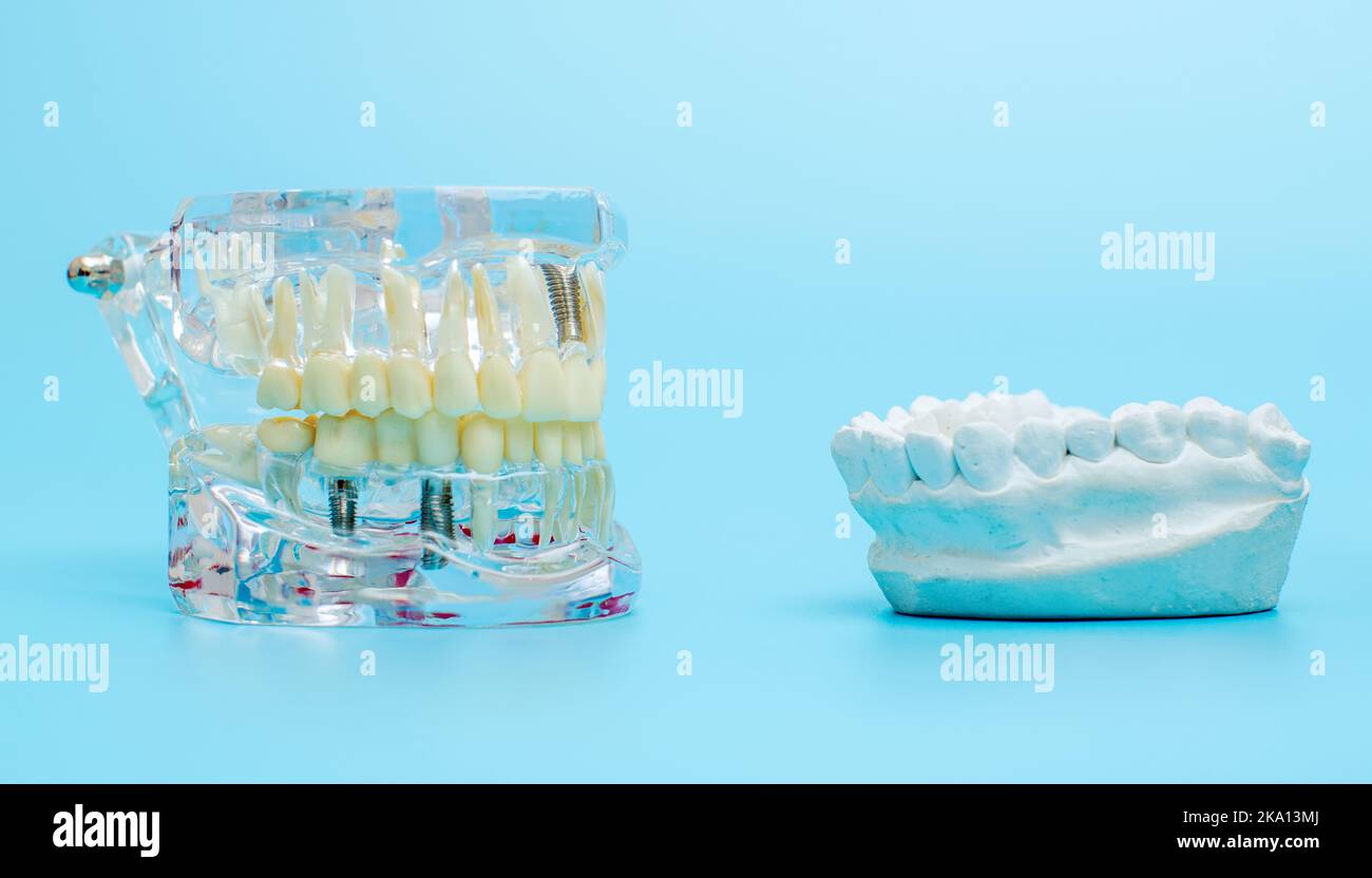 Compare tooth model and tooth model with metal wire dental Stock Photo ...