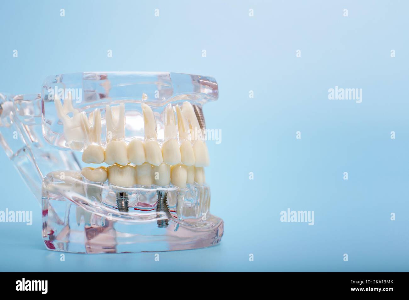 Dental jaw model over blue background. Dentist dental prosthetic teeth ...