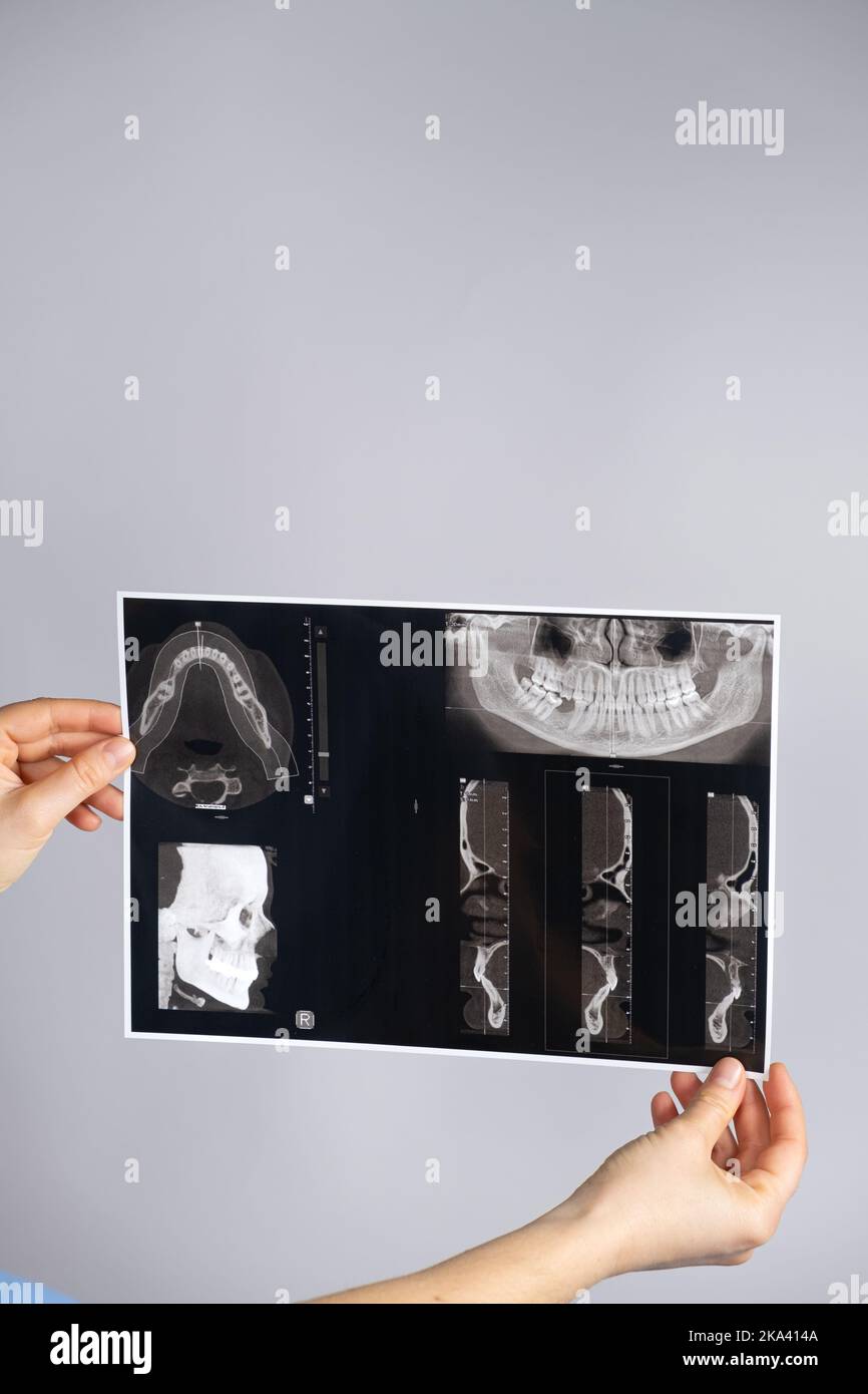 The doctor holds a CT scan of a patient with temporomandibular joint ...