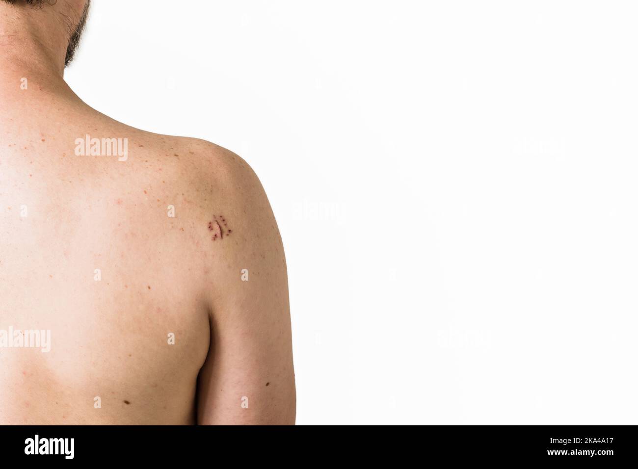 shoulder arthroscopy surgical metal staple suture. traumatologist ...