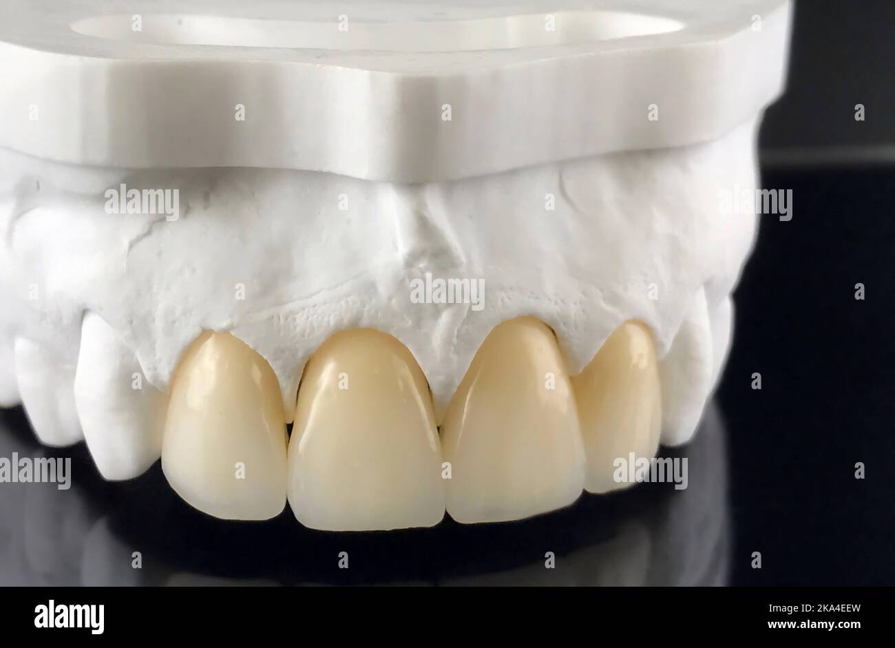Zirconia crowns with all porcelain baked. Dental crowns for the upper ...