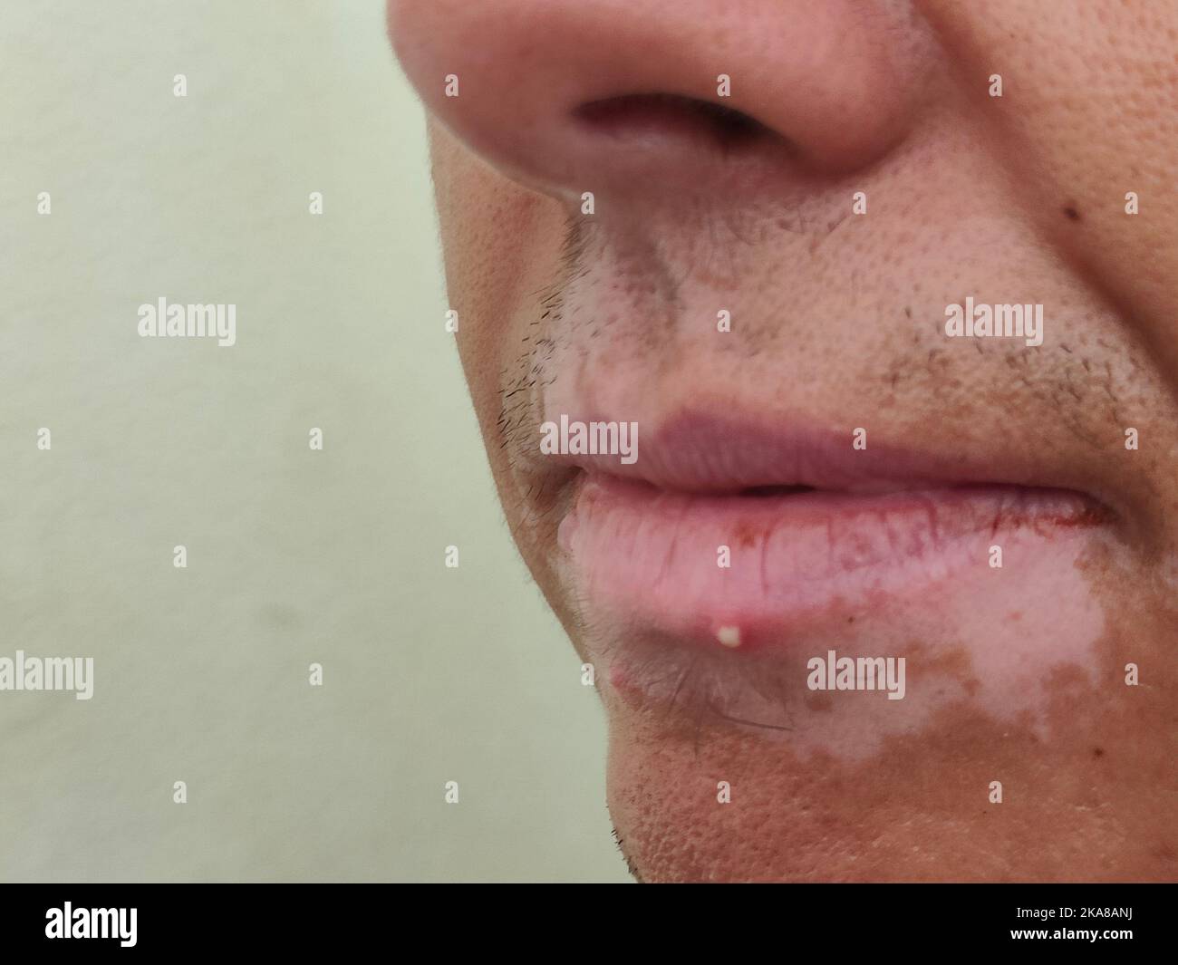 woman's lips with pimples on the face Stock Photo - Alamy