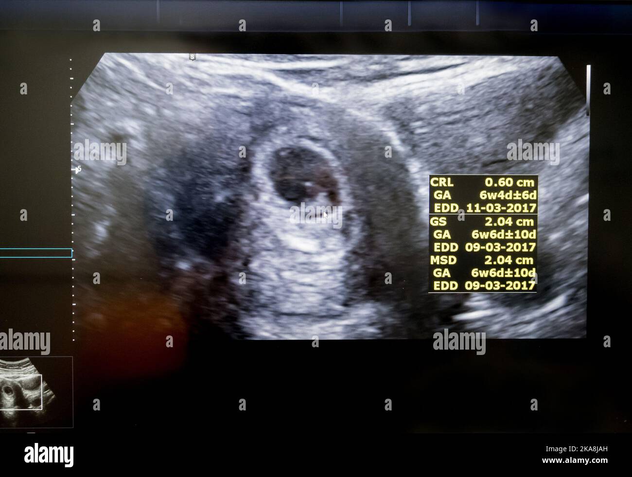 Obstetric Ultrasound of embryo at sixth week Stock Photo - Alamy