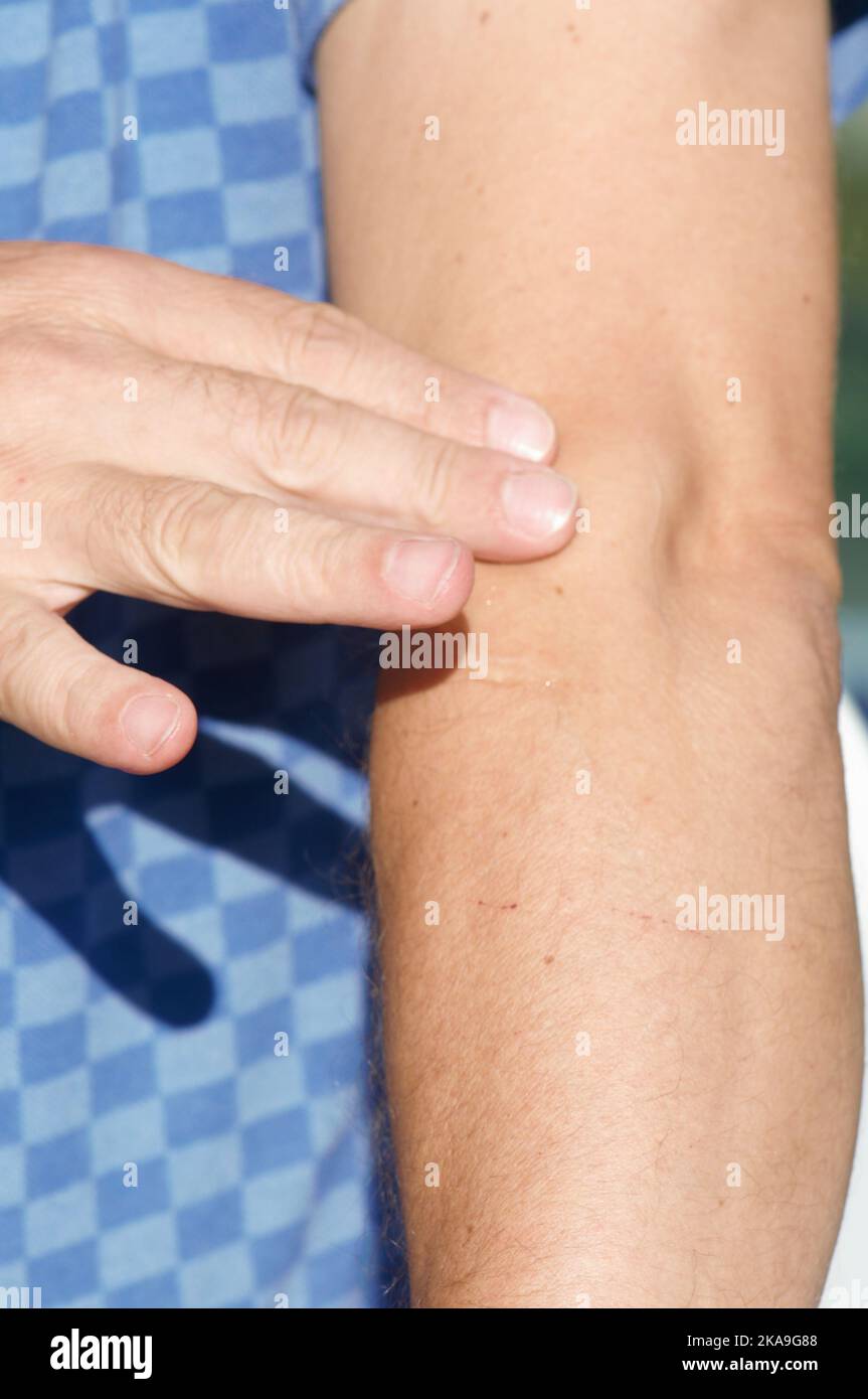 Skin rash on elbow hi-res stock photography and images - Alamy