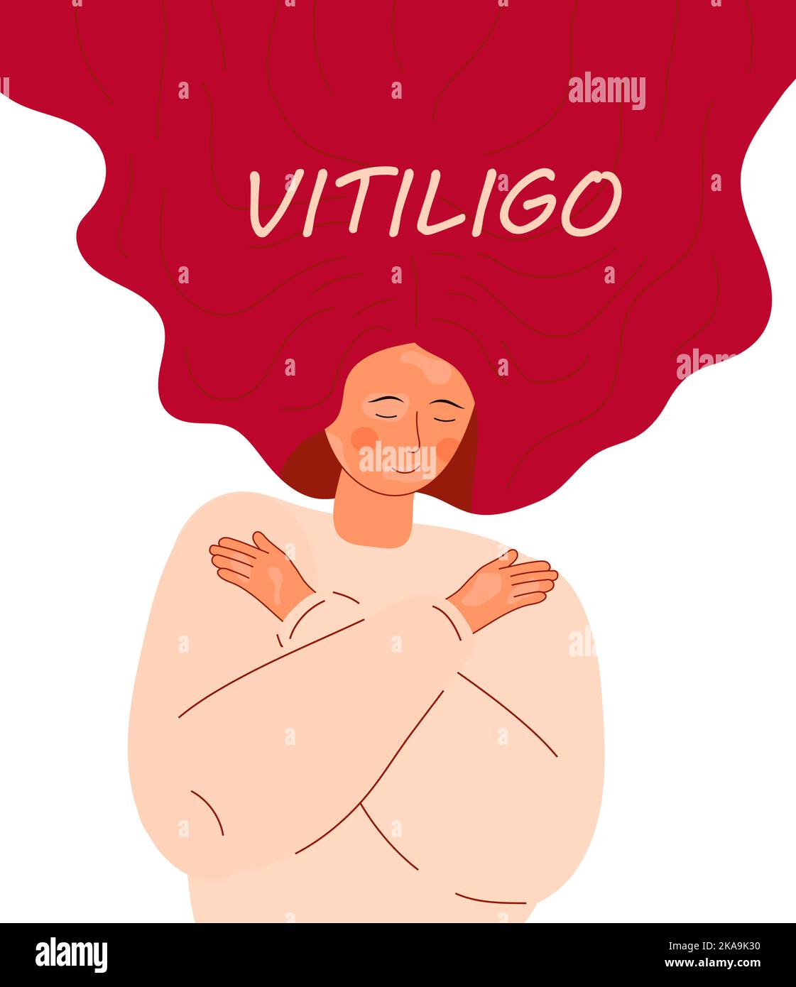 Vitiligo concept vector for web, app. World vitiligo day illustration ...