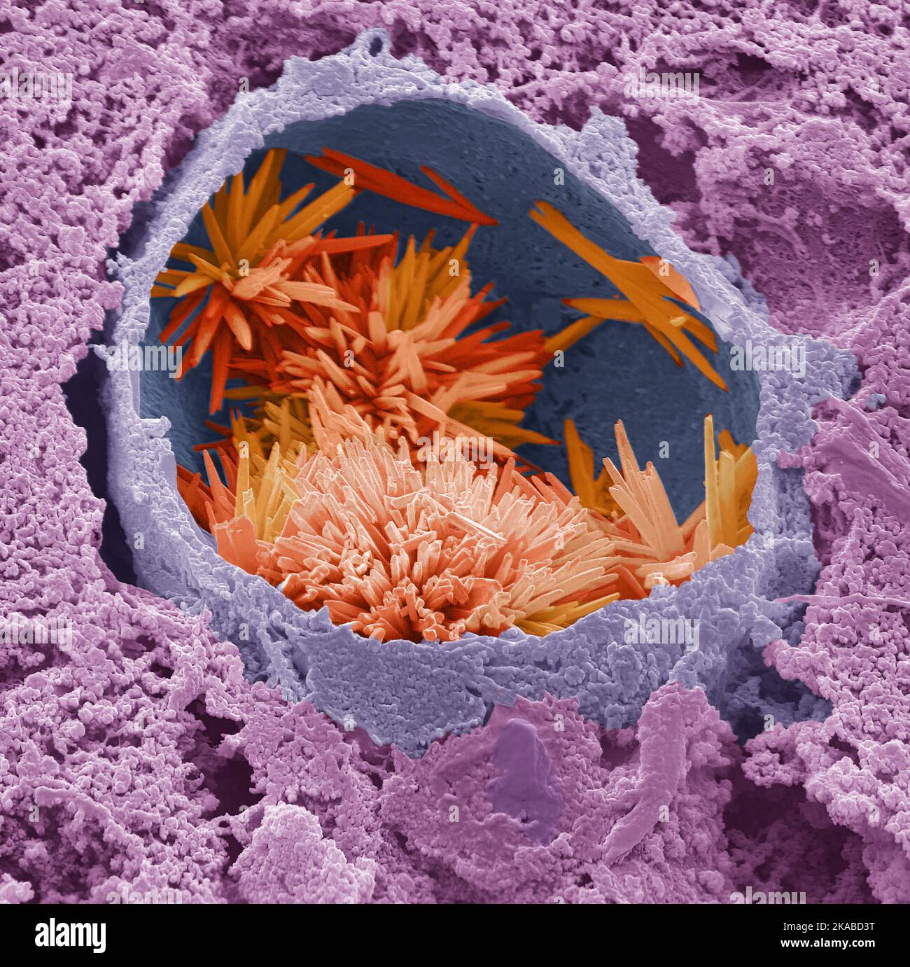 Cholesterol crystals in liver, SEM Stock Photo - Alamy