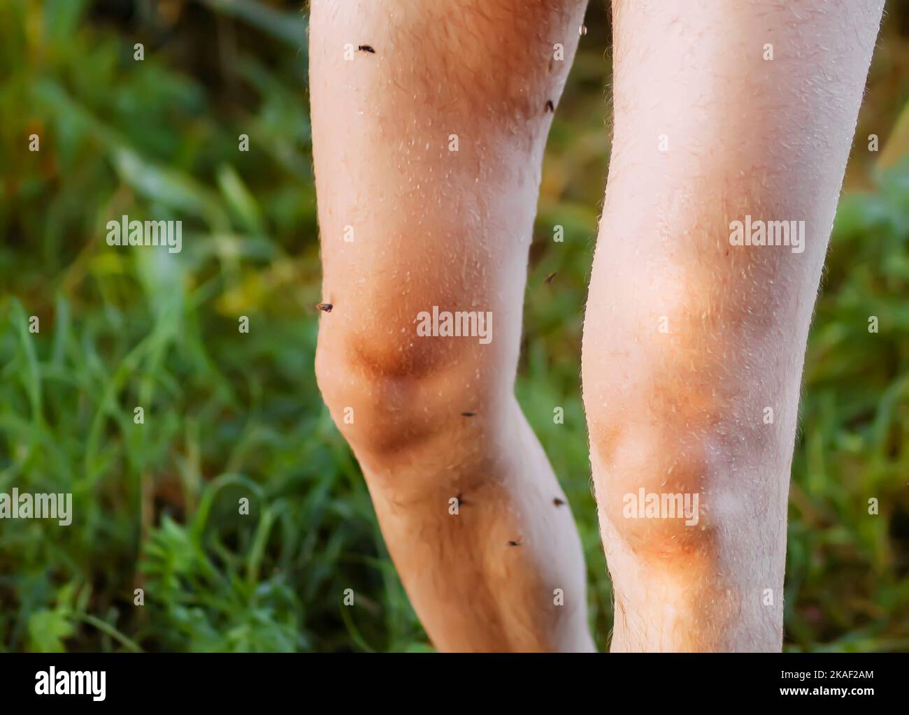 Insect bite on human skin Stock Photo - Alamy