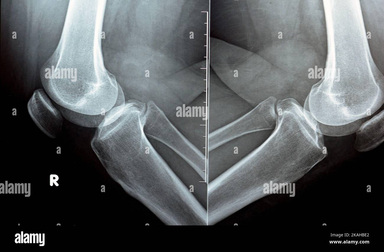 plain x ray on knee joint showing joint space narrowing and Subchondral Sclerosis on medial ...