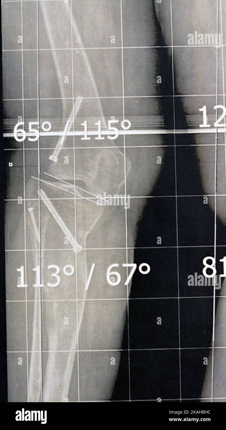 Plain x ray long film standing position showing both legs with ...