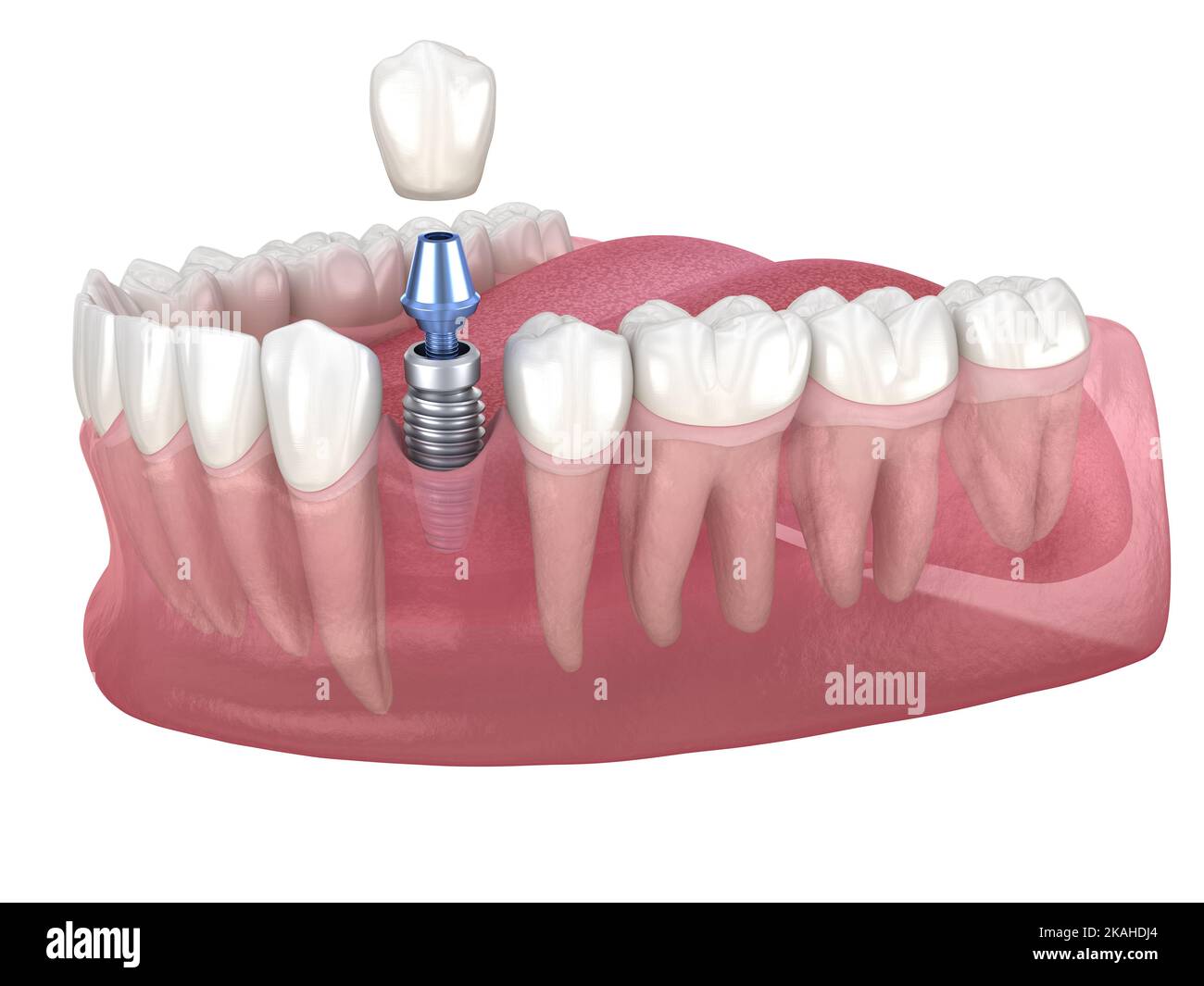 Premolar tooth recovery with implant. Medically accurate 3D ...