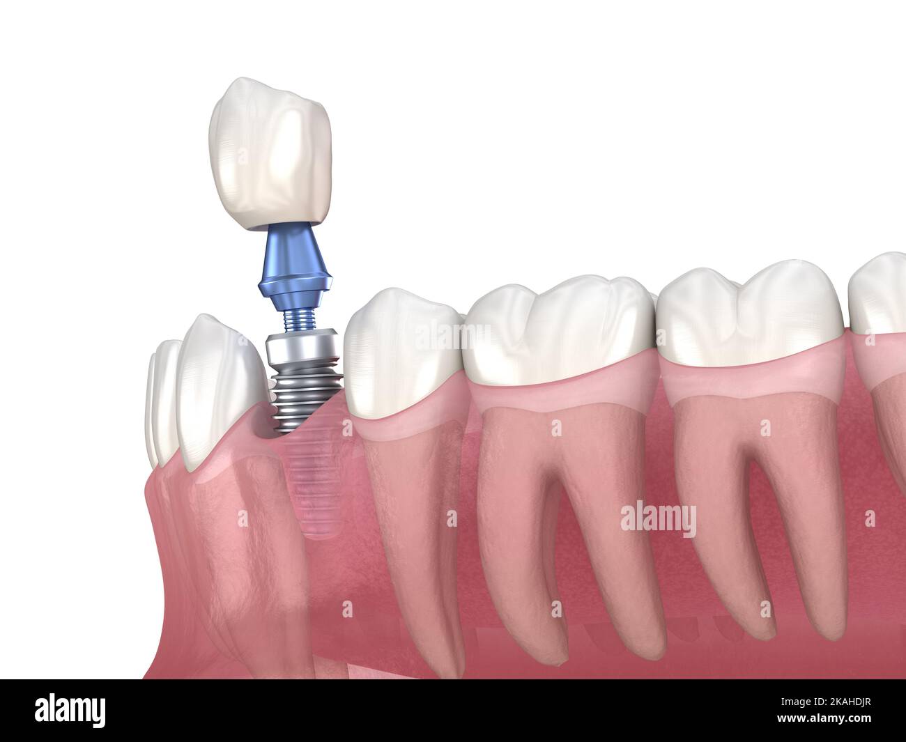 Premolar tooth recovery with implant. Medically accurate 3D ...