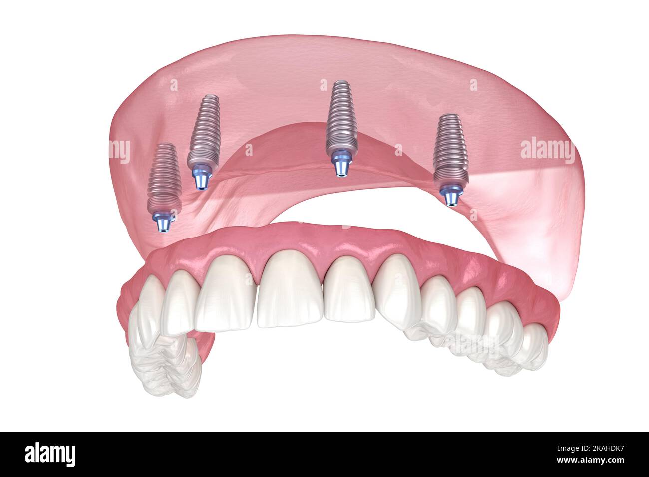 Maxillary prosthesis with gum All on 4 system supported by implants ...