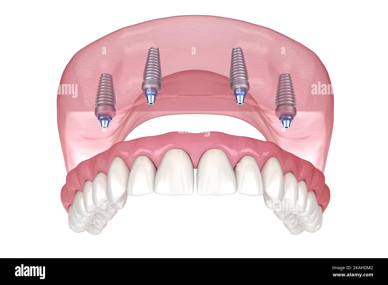 Maxillary prosthesis with gum All on 4 system supported by implants ...