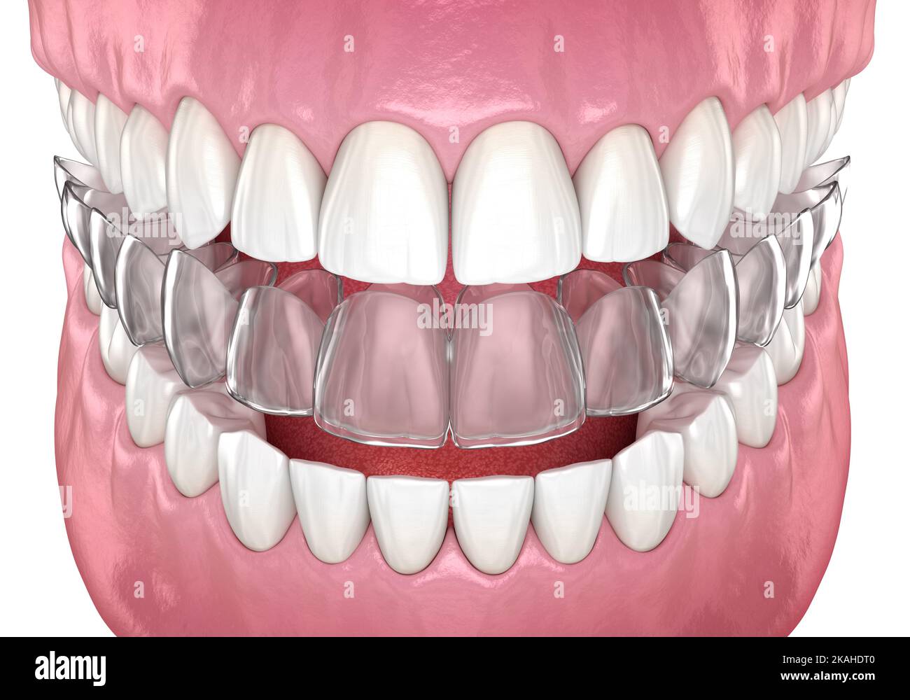 Invisalign braces or invisible retainer. Medically accurate dental 3D ...