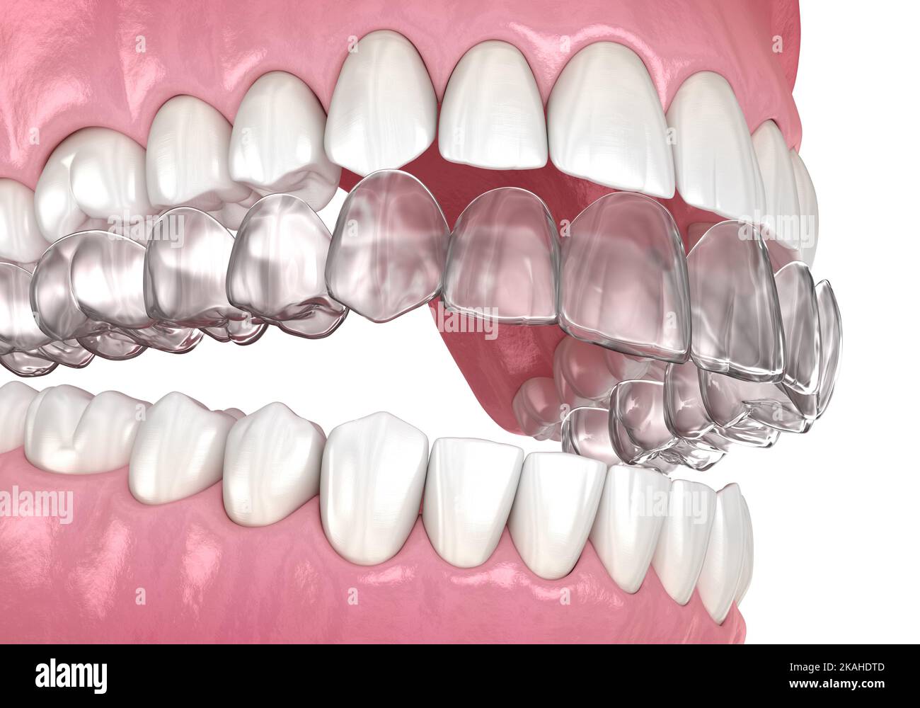 Invisalign braces or invisible retainer. Medically accurate dental 3D ...