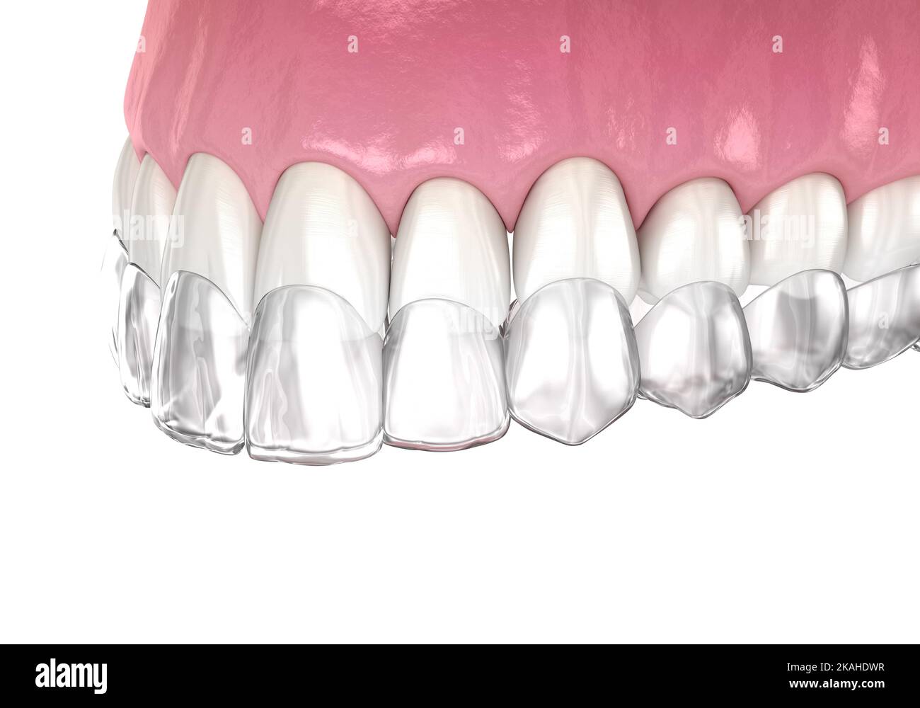 Invisalign braces or invisible retainer. Medically accurate dental 3D ...