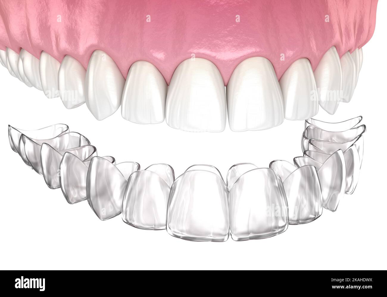 Invisalign braces or invisible retainer. Medically accurate dental 3D ...