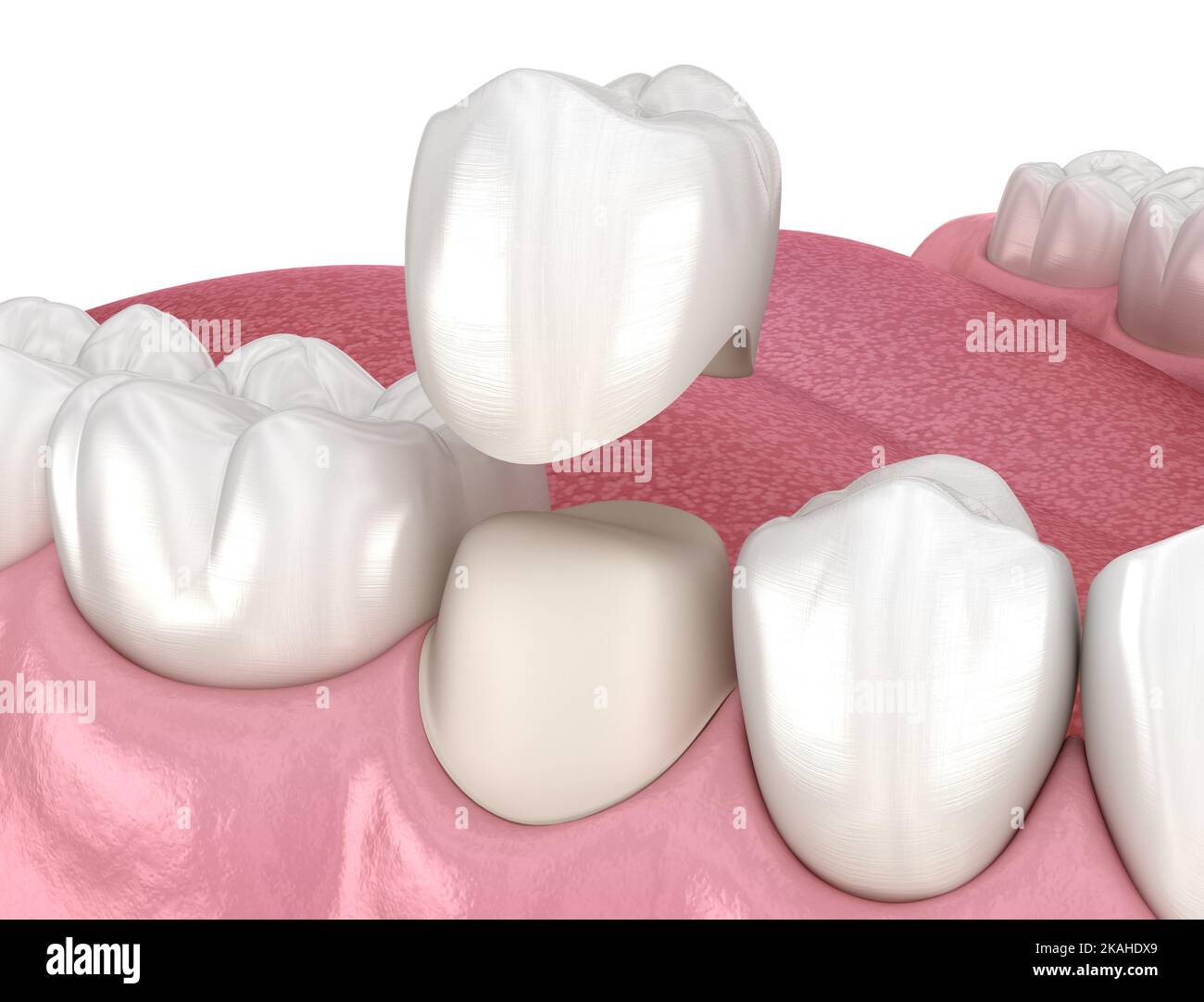 Preparated premolar tooth and dental crown placement. Medically ...