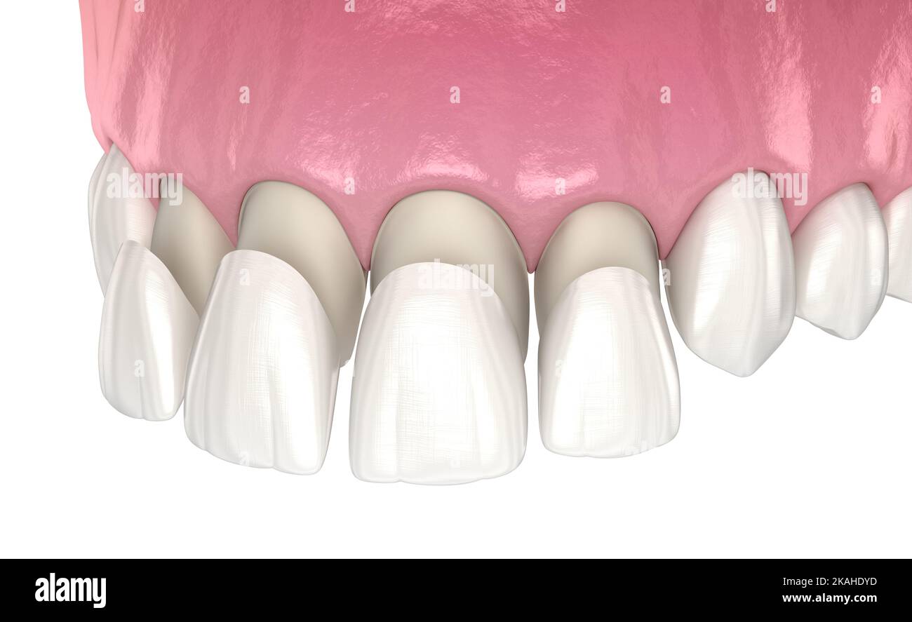 Veneer installation procedure over central incisor and lateral incisor ...