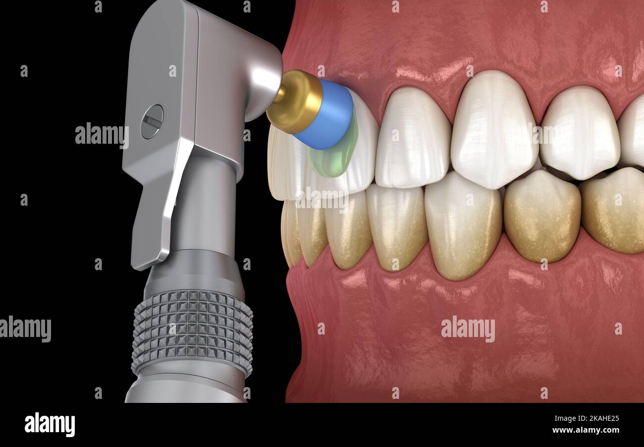 Teeth polishing procedure with professional brush and gel. Medically ...