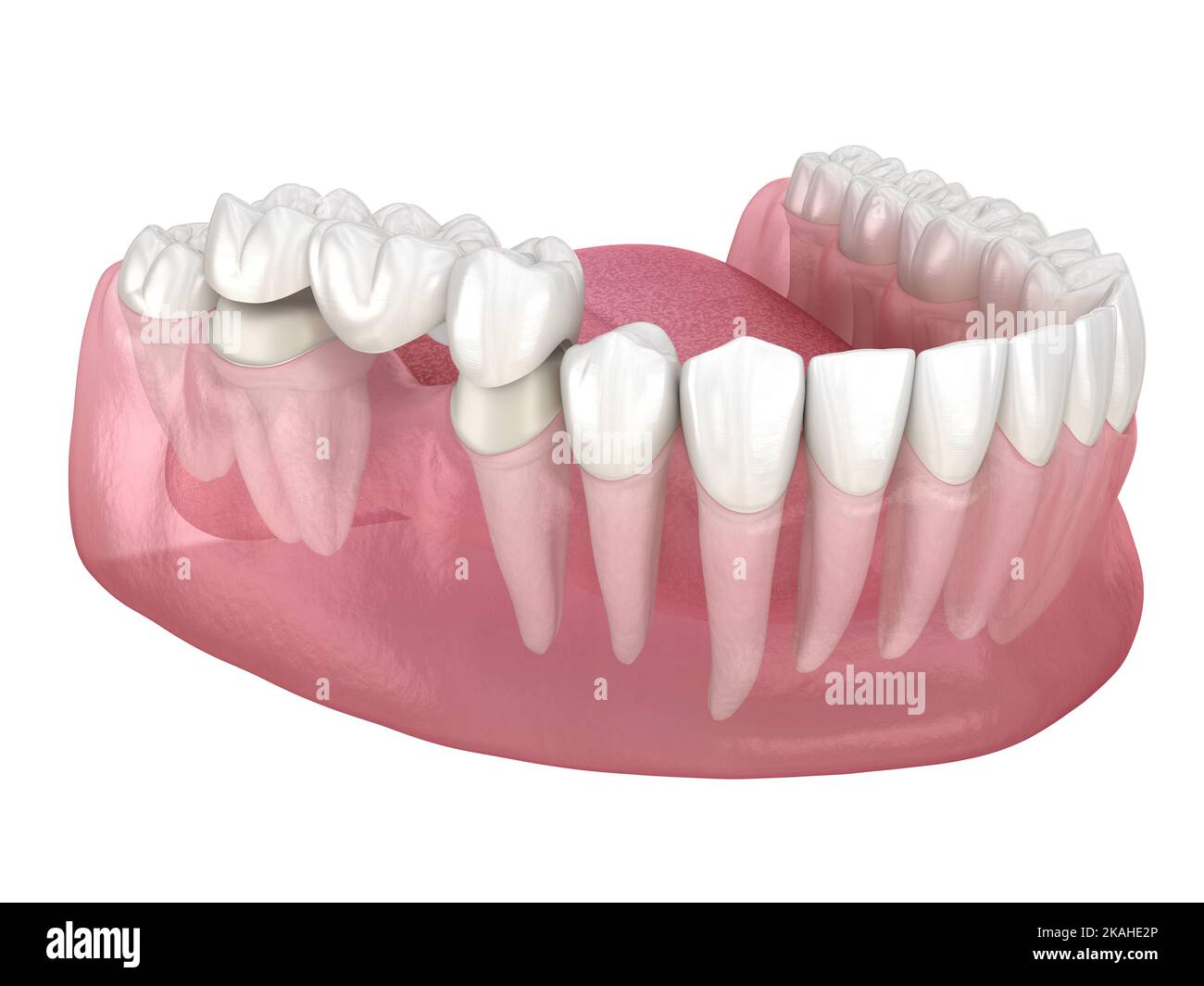 Dental bridge of 3 teeth over molar and premolar. Medically accurate 3D ...