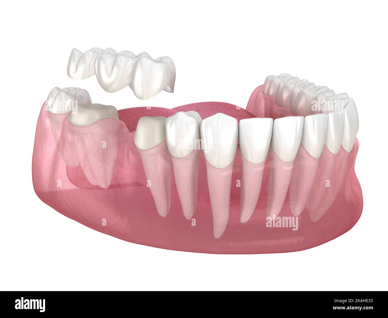 Dental bridge of 3 teeth over molar and premolar. Medically accurate 3D ...