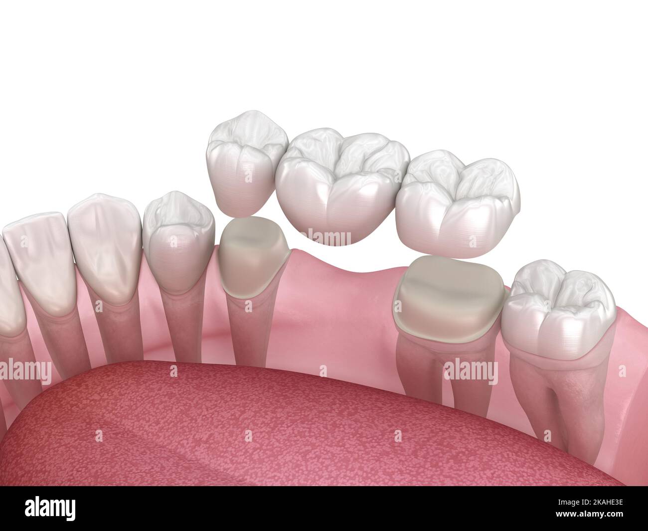 Dental bridge of 3 teeth over molar and premolar. Medically accurate 3D ...
