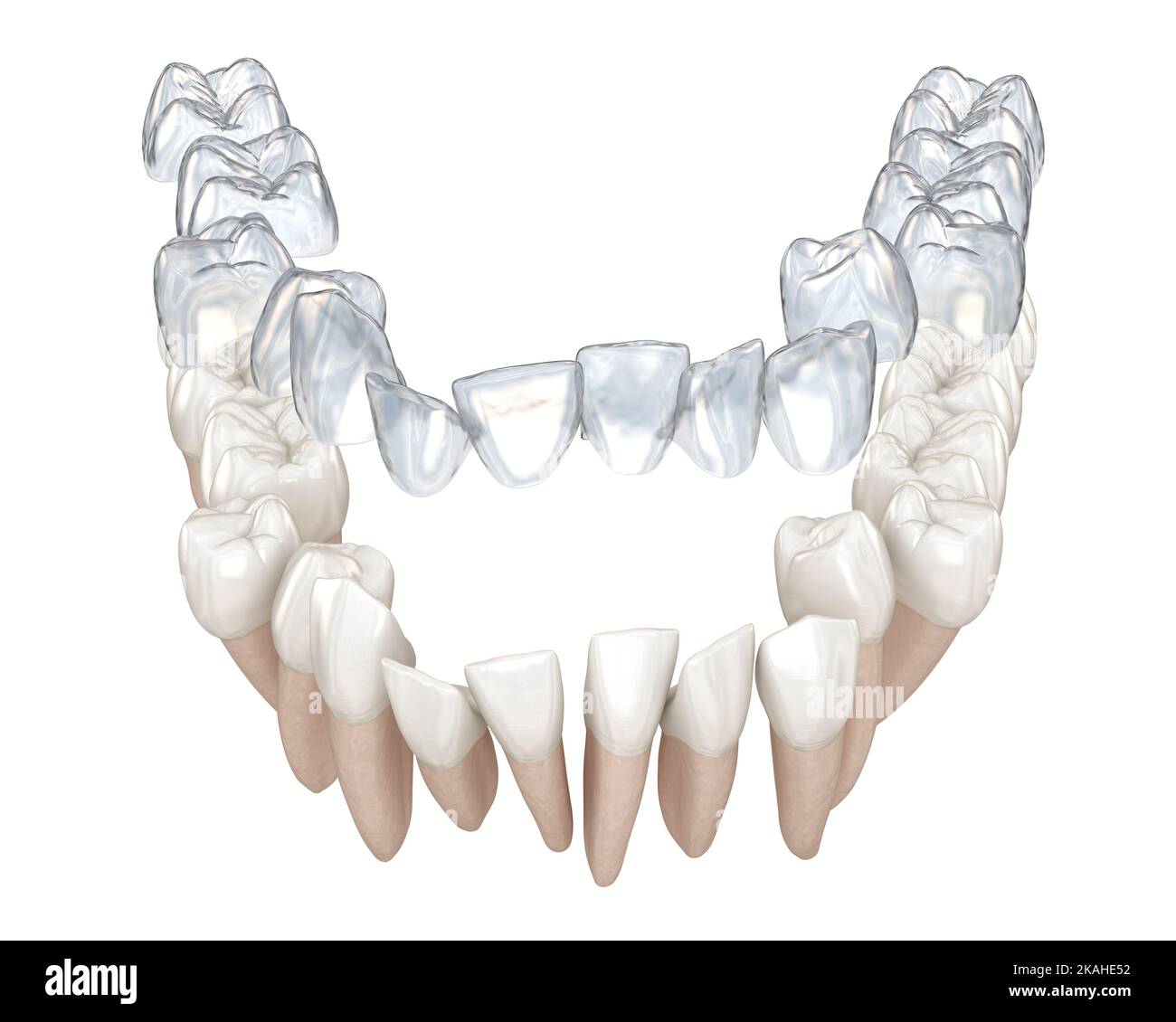 Invisalign braces or invisible retainer make bite correction. Medically ...