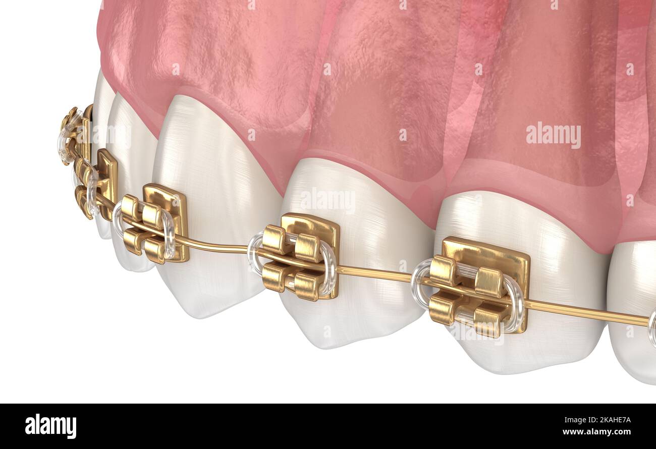 Golden braces tretament, macro view. Medically accurate dental 3D ...