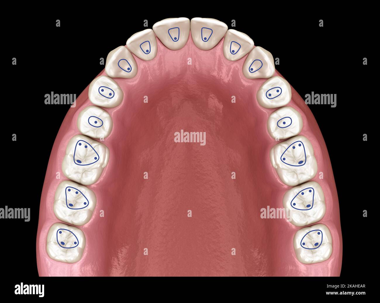 Root canal orifice locations plan of maxillary jaw. 3D illustration ...