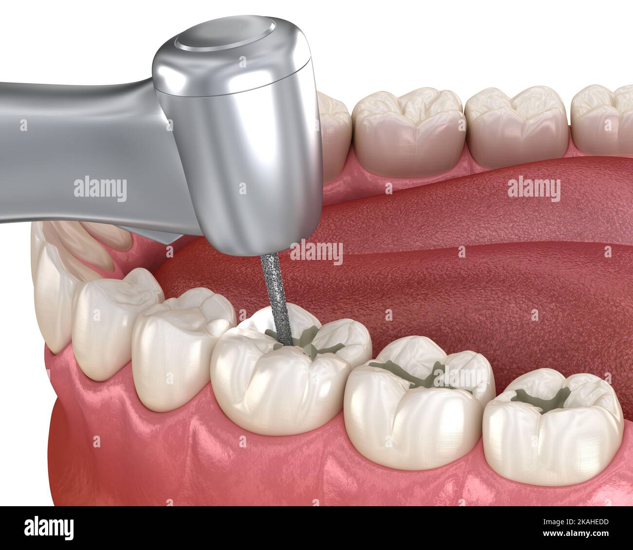 Fissure Preparation for fillings placement, Medically accurate 3D ...