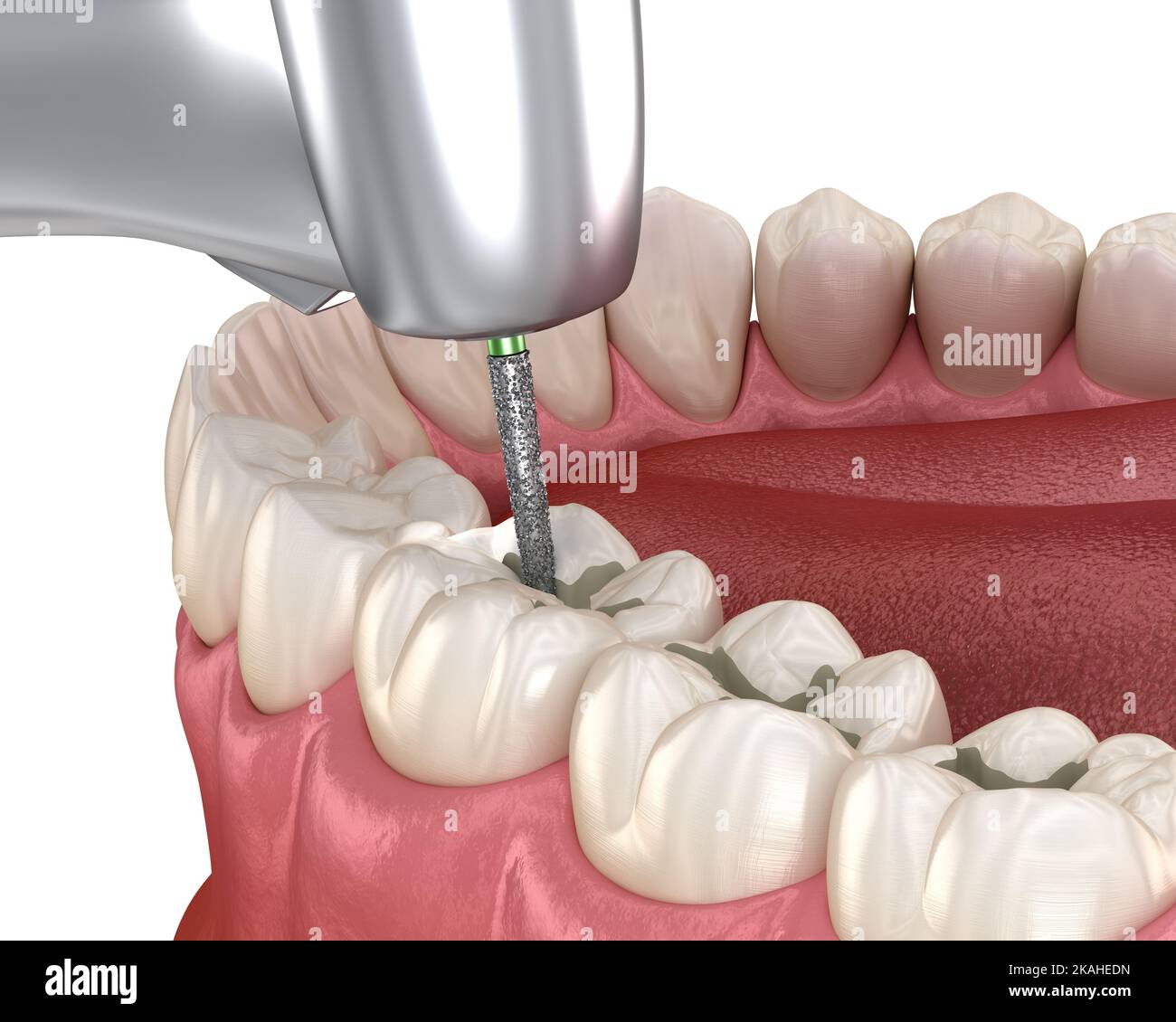 Fissure Preparation for fillings placement, Medically accurate 3D ...