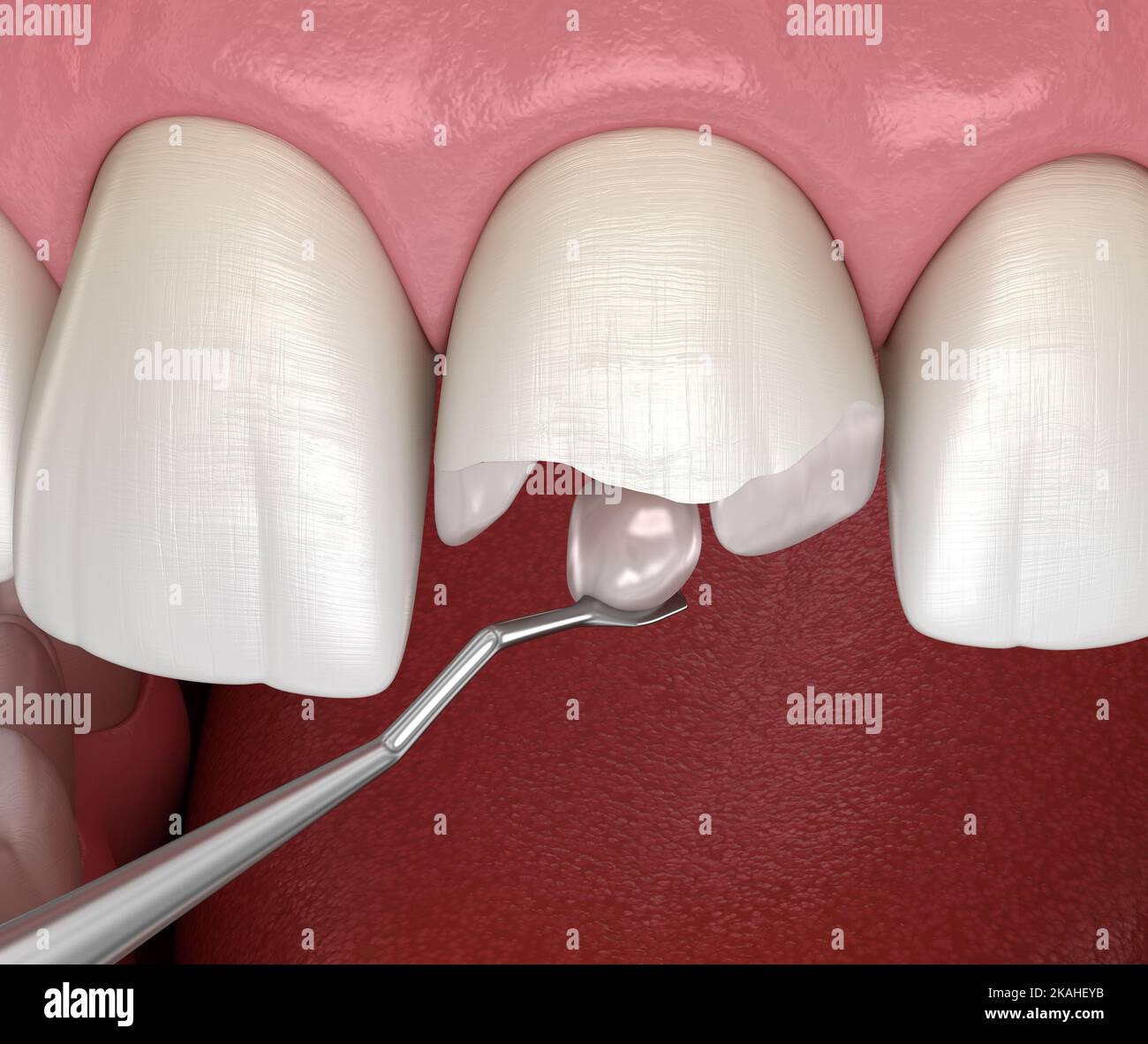 Restoration of broken tooth. Medically accurate 3D illustration Stock ...